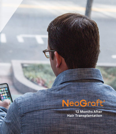 Neograft FUE Hair Transplant Surgery Men Women | Raleigh NC